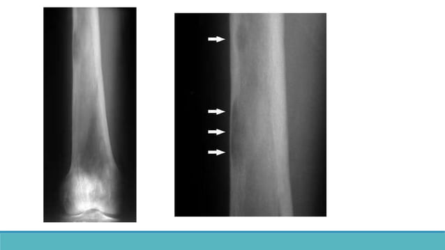 hyperparathyroidism imaging metabolic bone disease.pptx