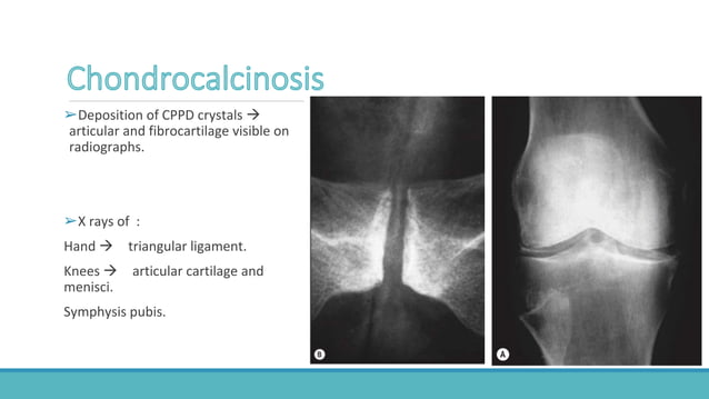 hyperparathyroidism imaging metabolic bone disease.pptx