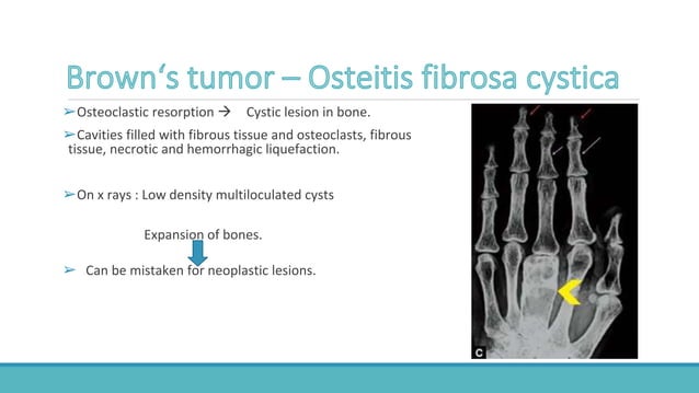 hyperparathyroidism imaging metabolic bone disease.pptx