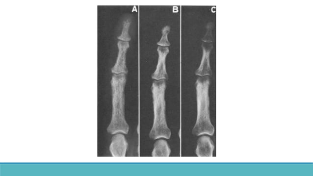 hyperparathyroidism imaging metabolic bone disease.pptx