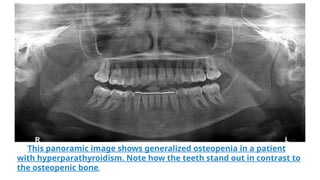hyperparathyroidism , it's effects on jaws and teeth | PPTX