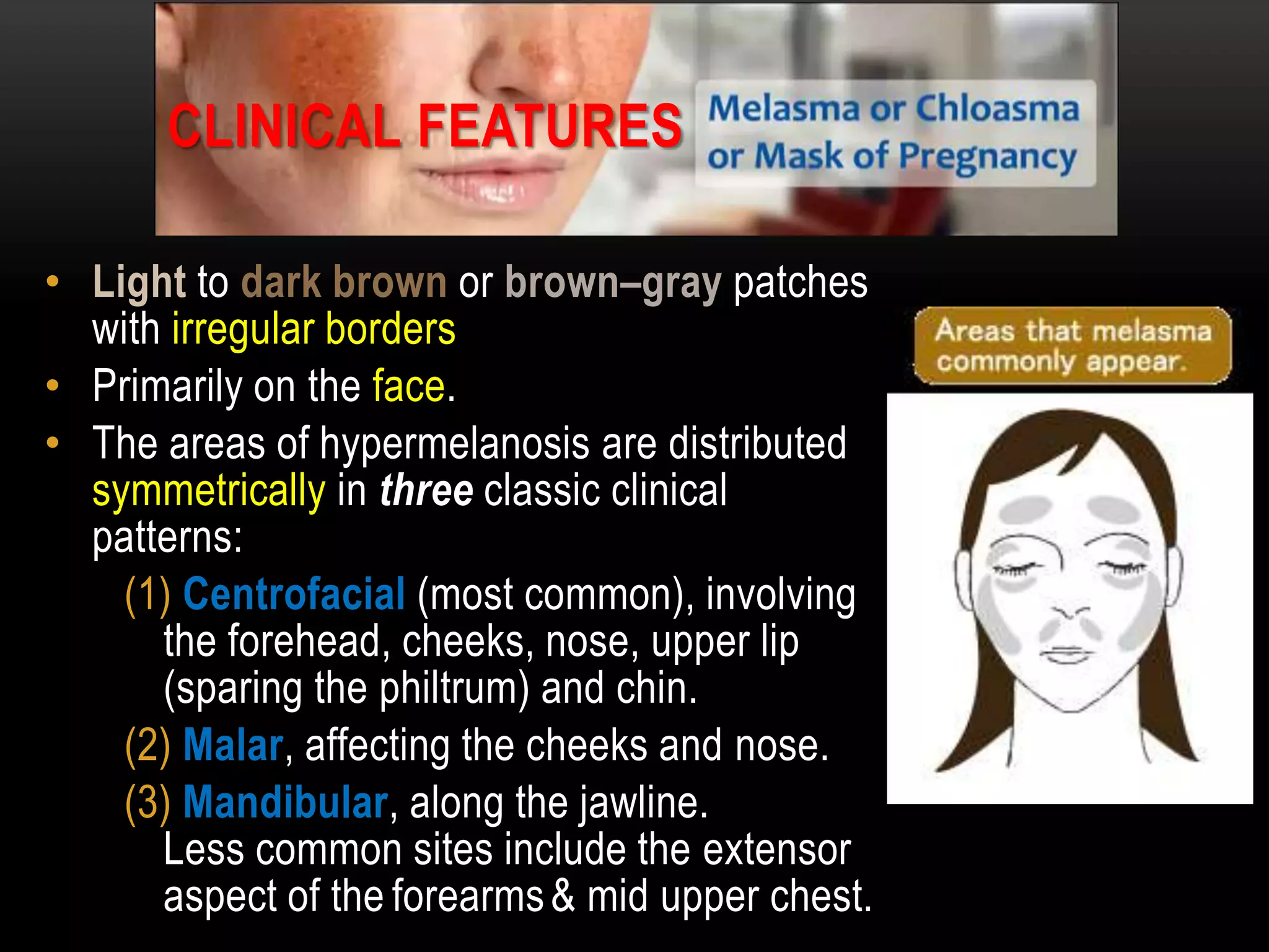 Disorders of Hyperpigmentation | PPTX