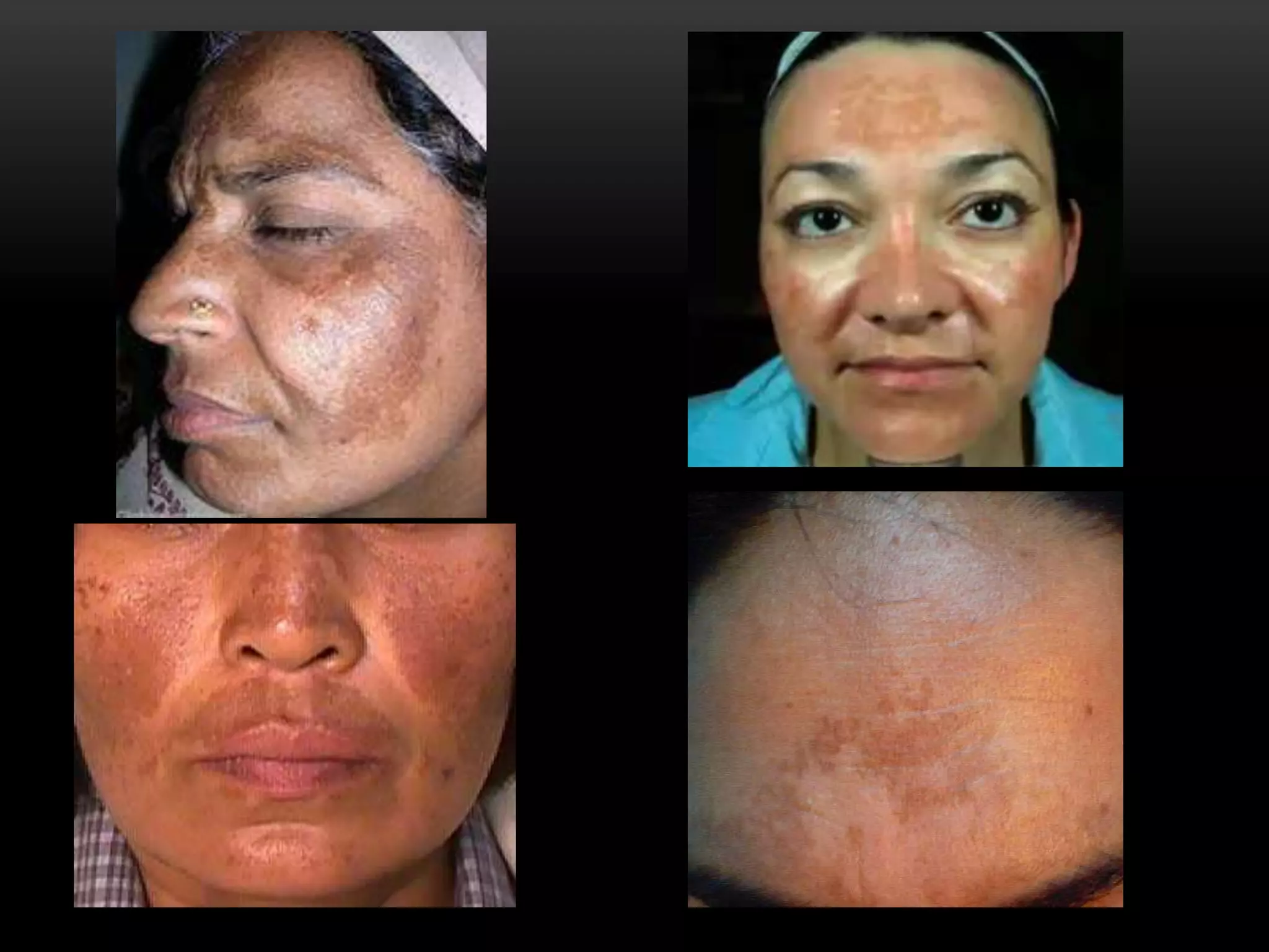 Disorders of Hyperpigmentation | PPTX