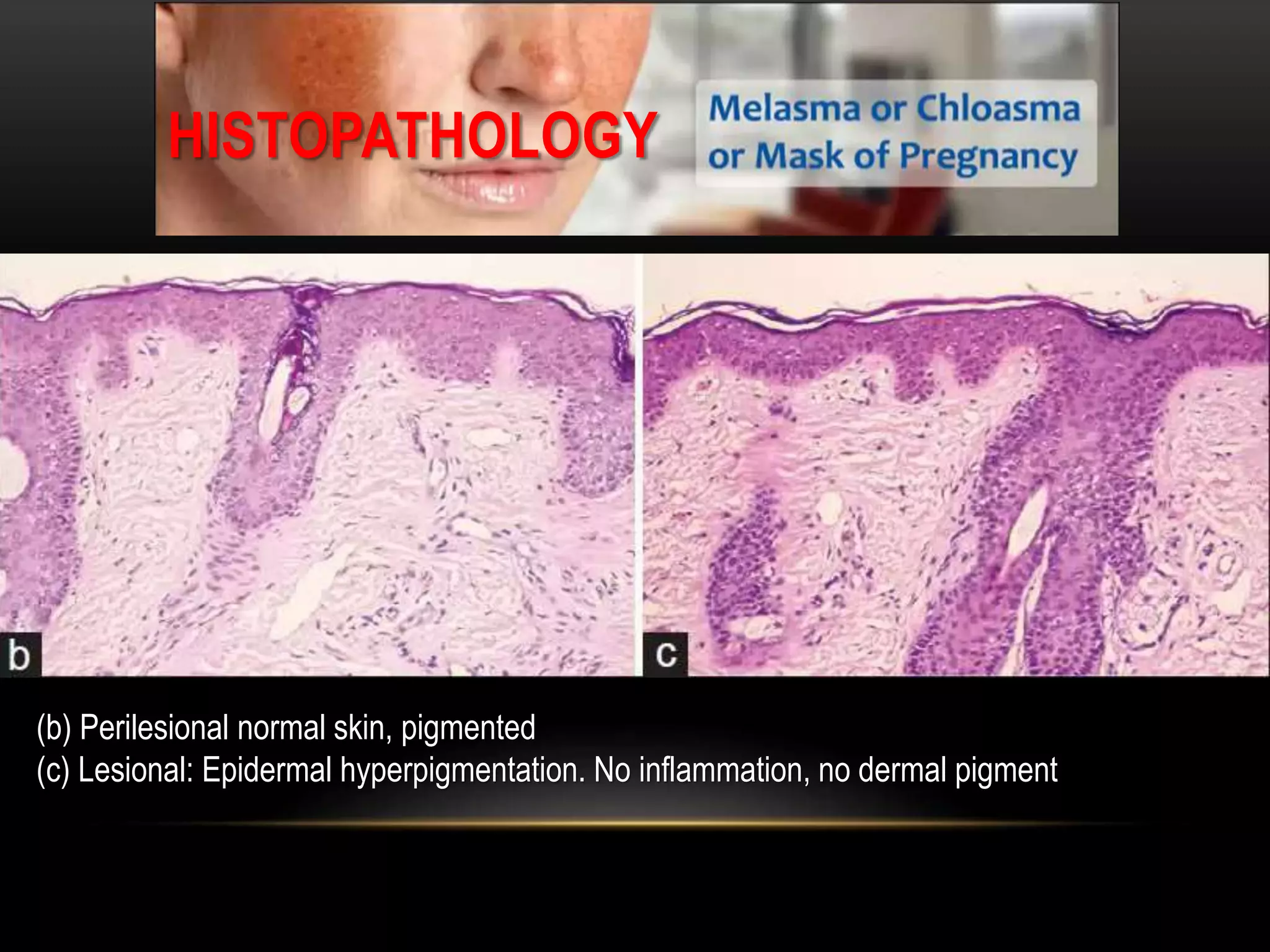 Disorders of Hyperpigmentation | PPTX