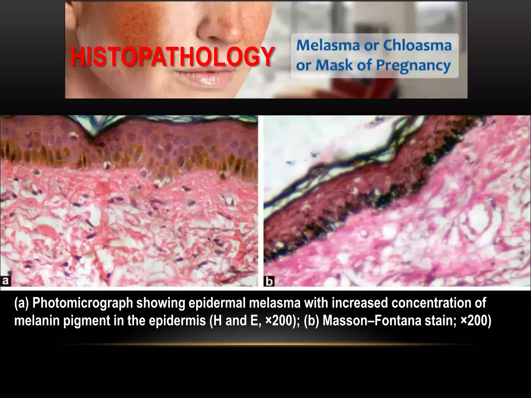 Disorders of Hyperpigmentation | PPTX