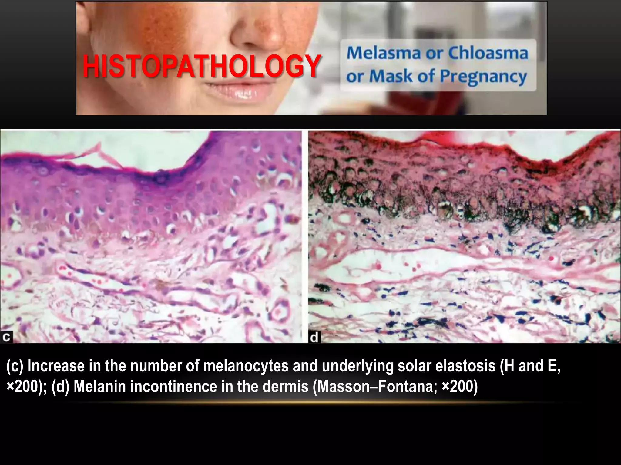Disorders of Hyperpigmentation | PPTX