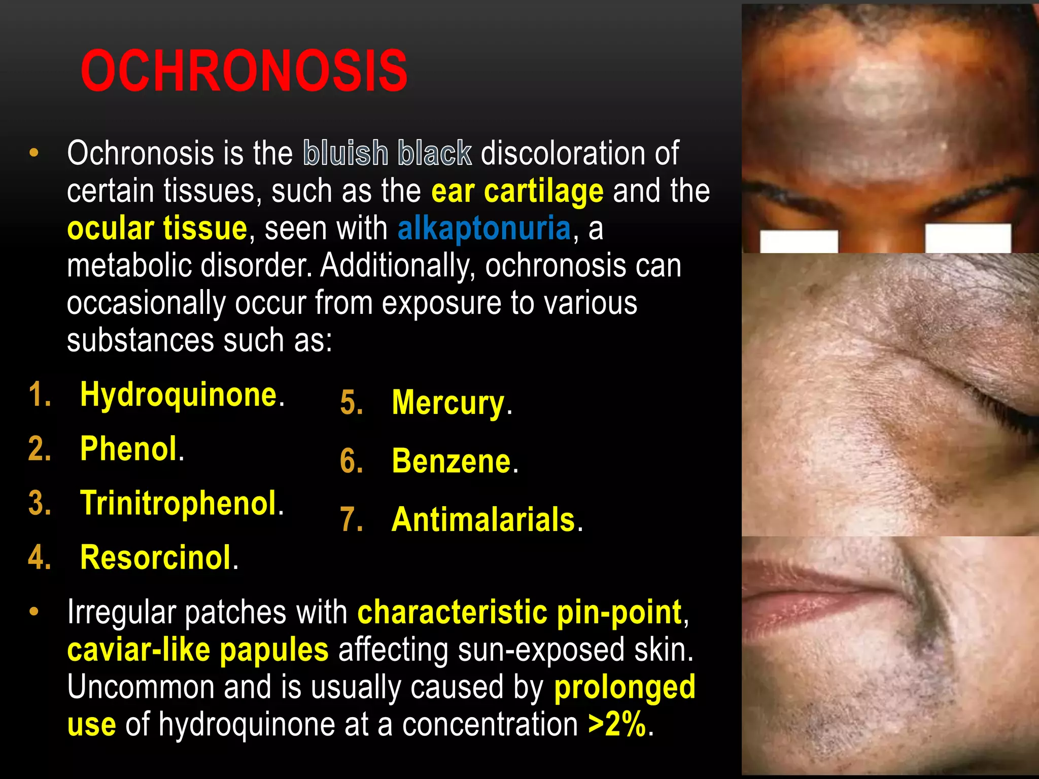 Disorders of Hyperpigmentation | PPTX