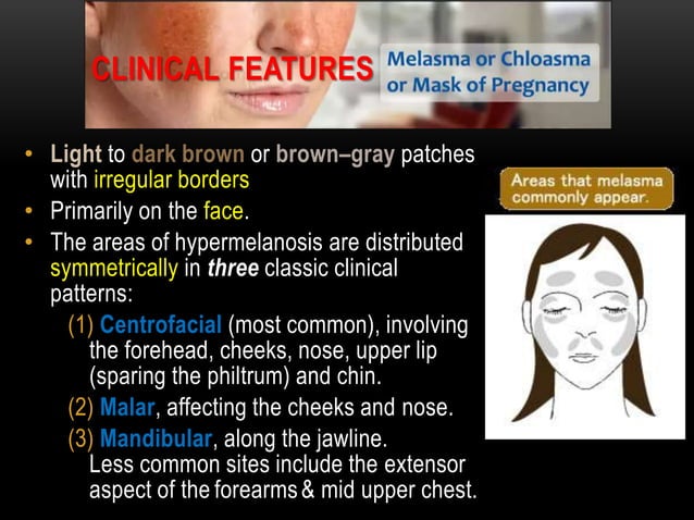 Disorders of Hyperpigmentation | PPTX | Skin and Dermatology | Diseases ...
