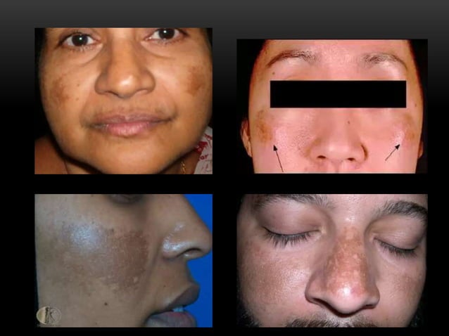 Disorders of Hyperpigmentation | PPTX | Skin and Dermatology | Diseases ...