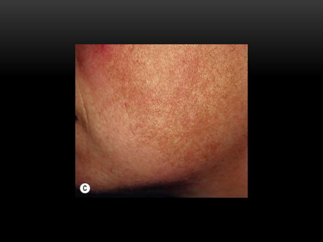 Disorders of Hyperpigmentation | PPTX | Skin and Dermatology | Diseases ...