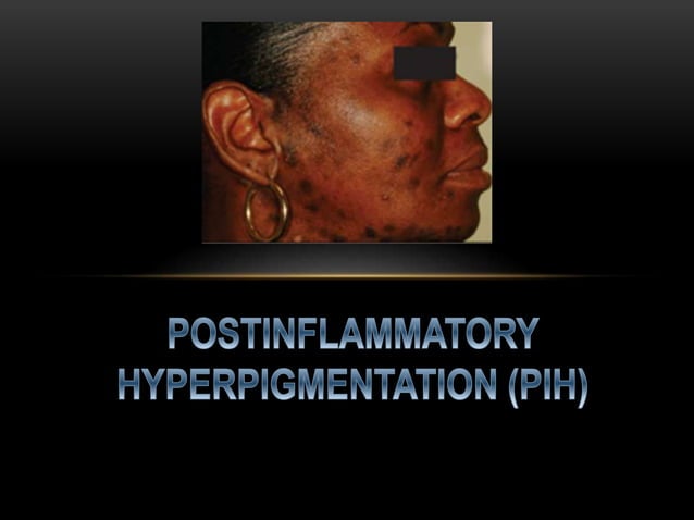 Disorders of Hyperpigmentation | PPTX | Skin and Dermatology | Diseases ...
