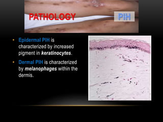 Disorders of Hyperpigmentation | PPTX
