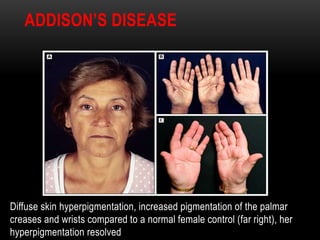 Disorders of Hyperpigmentation | PPTX