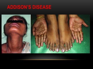 Addisons Disease Skin Pigmentation Pictures