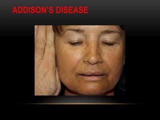 Addisons Disease Face