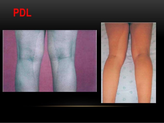 Disorders of Hyperpigmentation