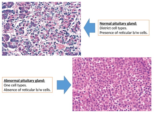 hyperpituitarism.pptx. . | PPTX | Endocrine and Metabolic Diseases ...