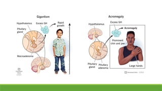 Hyperpituitarism.pptx for nursing studen | PPTX