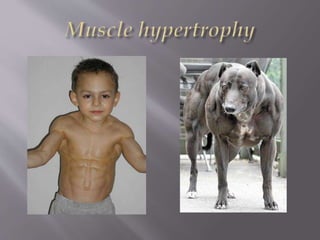 Muscle Hypertrophy Disease In Kids