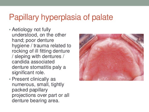 Hyperplasia