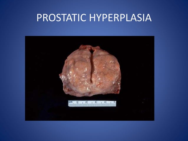 Hyperplasia | PPTX | Endocrine and Metabolic Diseases | Diseases and Conditions