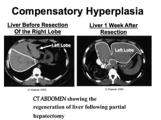 Hyperplasia | PPTX