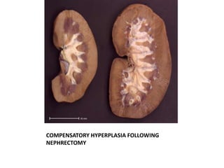 Hyperplasia | PPT