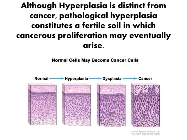 Hyperplasia | PPT