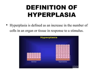 Hyperplasia | PPT
