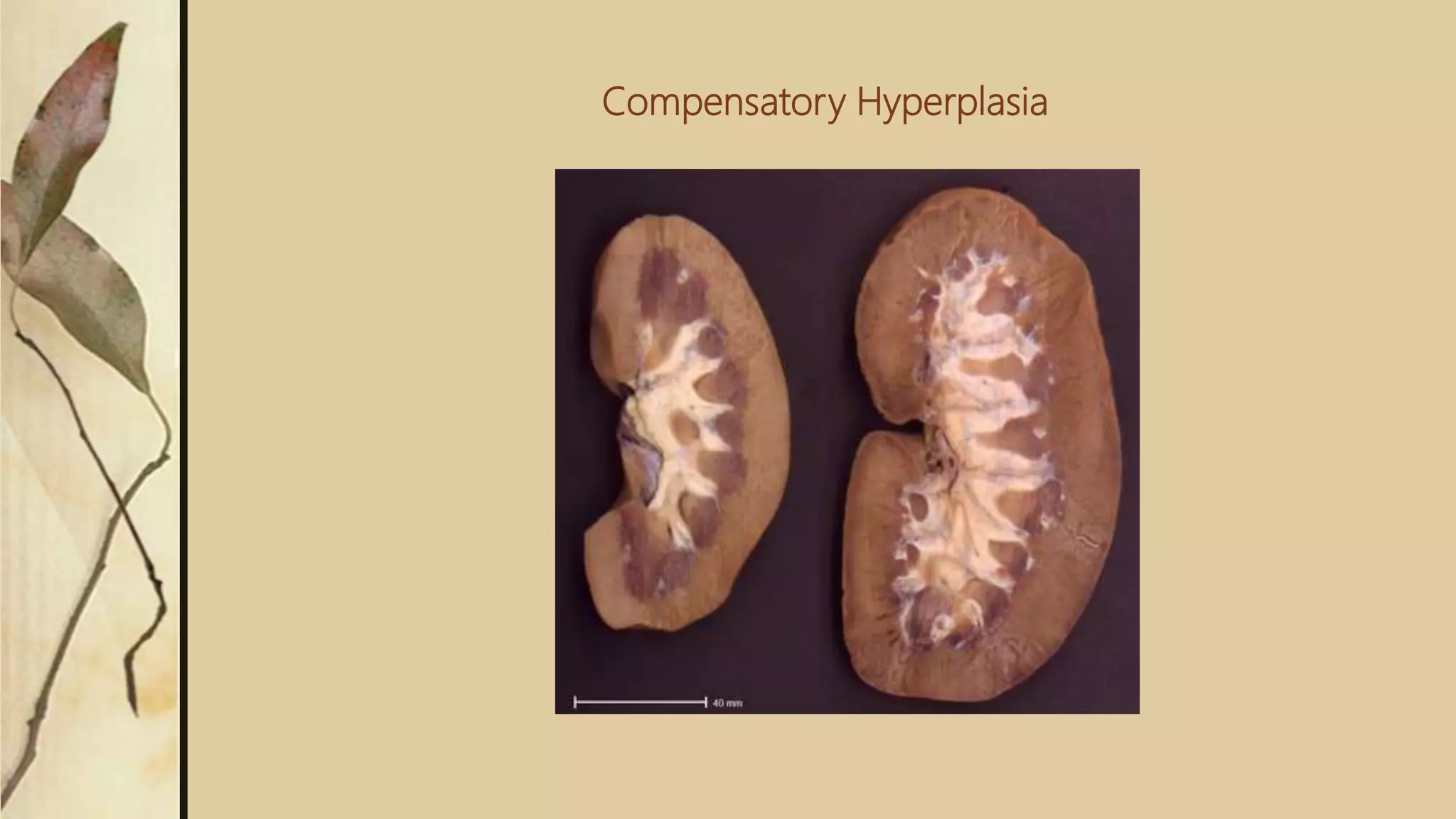 Hyperplasia (1) | PPTX | Hormonal Disorders | Endocrine and Metabolic ...