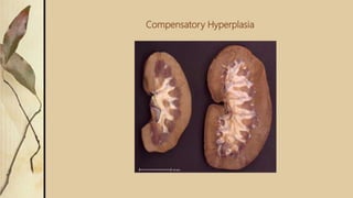 Hyperplasia (1) | PPTX