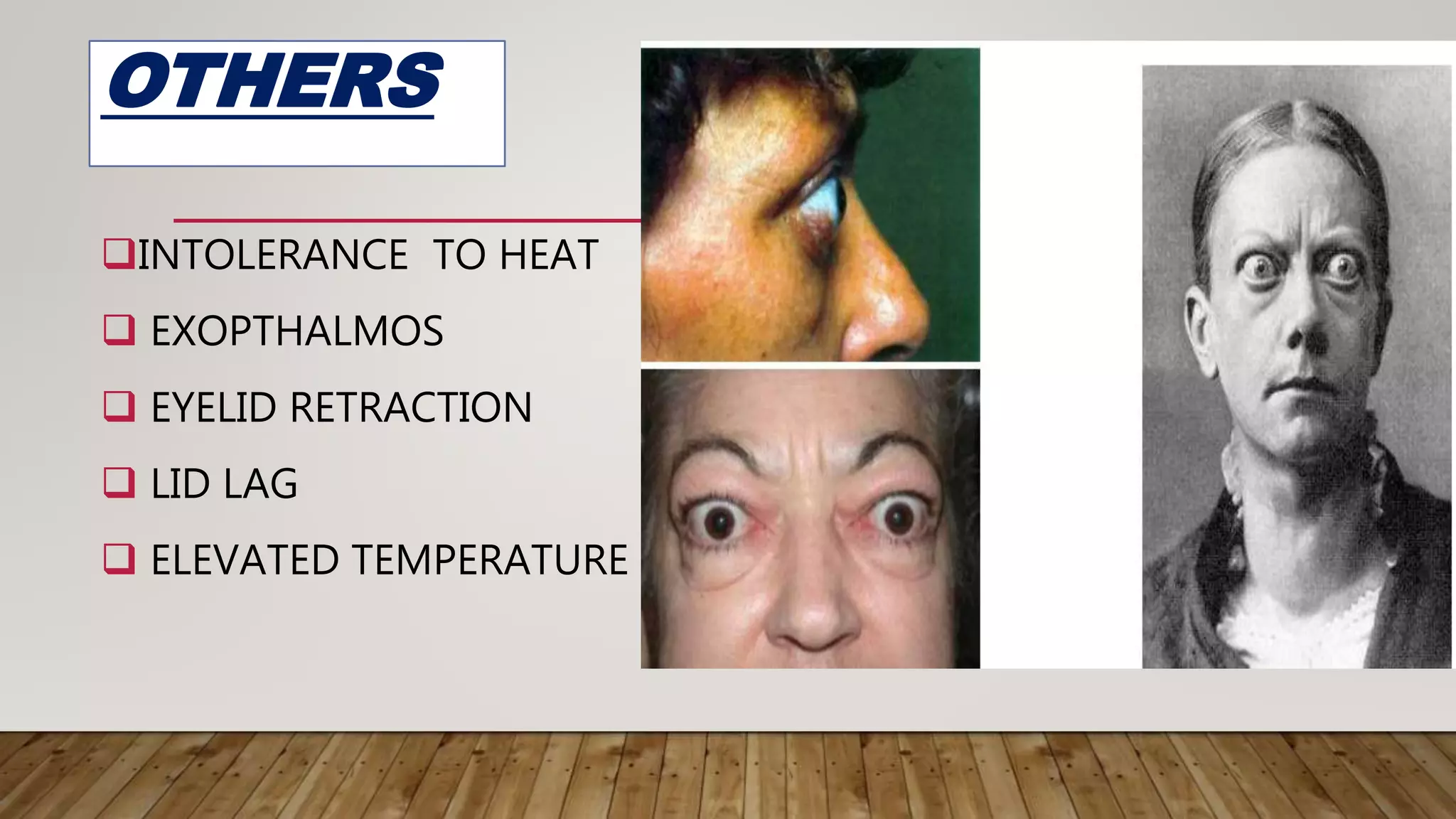 Hyperthyroidism - clinical features, cause, management, surgery | PPTX