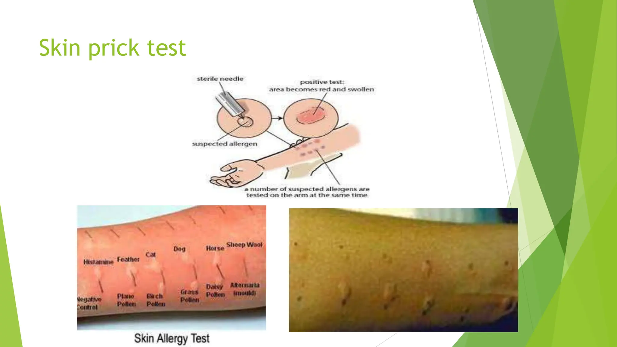 Hypersensitivity- types of hypersensitivity.pptx | Blood Disorders ...