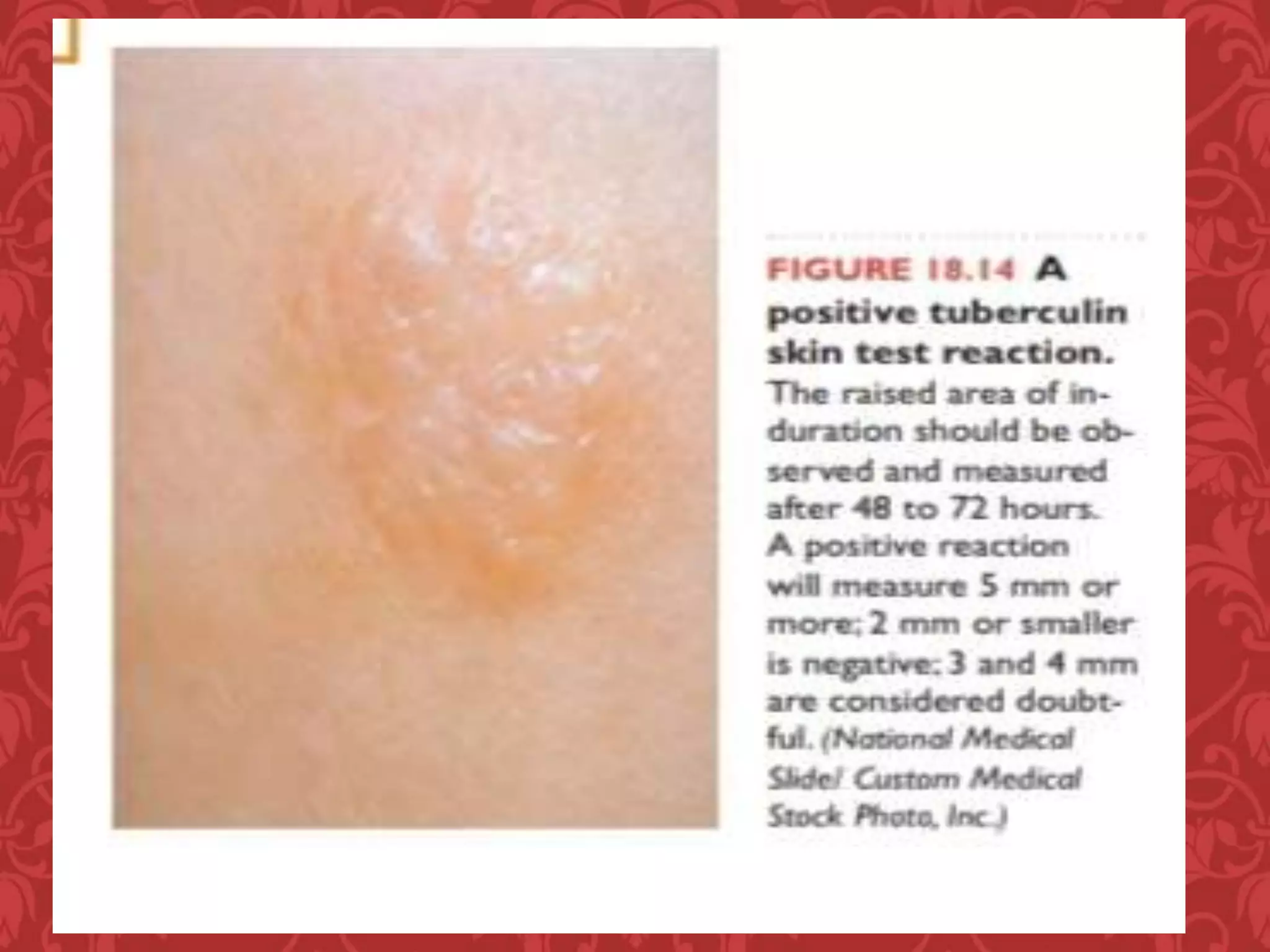 Hypersensitivity and its types ( type 1 anaphylaxis, type 2, Type 3 ...