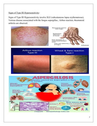 Hypersensitivity and its types (1).pdf