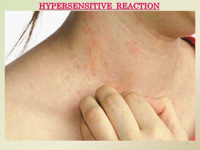 Hypersensitivity or Allergic Reactions | PPTX