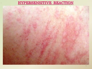 Hypersensitivity or Allergic Reactions | PPTX