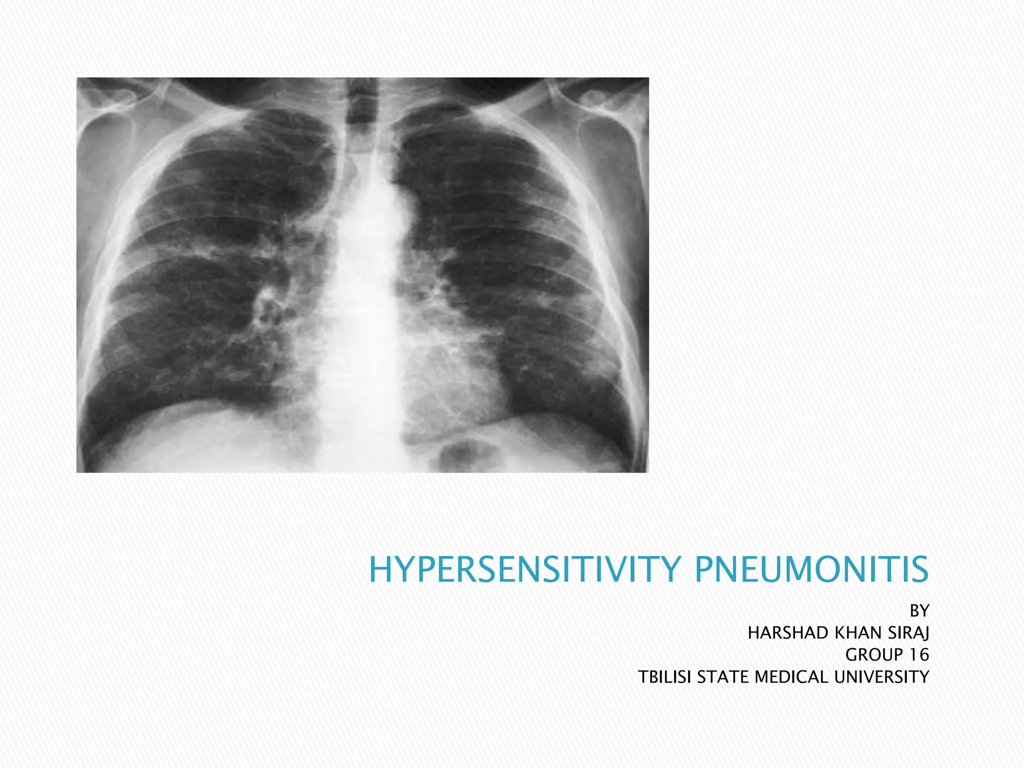 Hypersensitivity pneumonitis | PPTX
