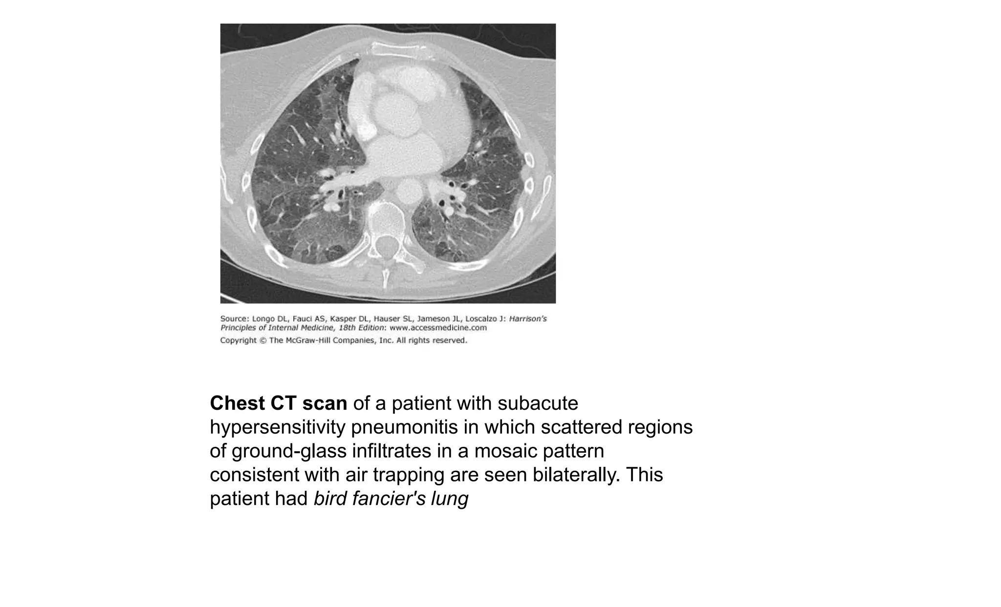 Hypersensitivity Pneumonitis and Pulmonary Infiltrates with ...