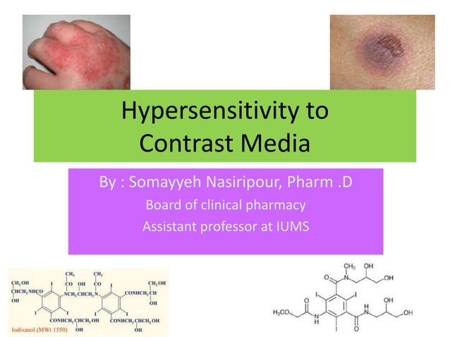 Hypersensitivity to Contrast Media | PPTX | Skin and Dermatology ...