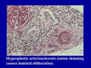 Hyperplastic Arteriosclerosis