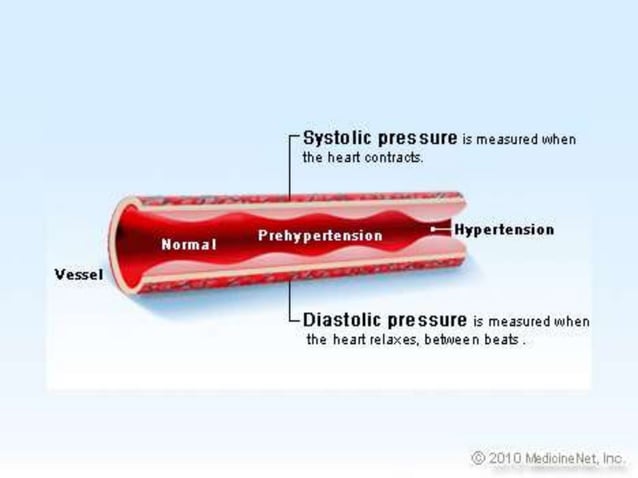 Hypertension Hypertension types causes and management complications ...