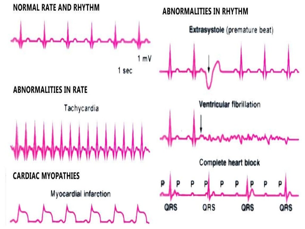 Hypertension Hypertension types causes and management complications c…
