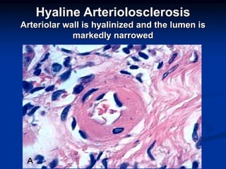 Hyaline Arteriolosclerosis