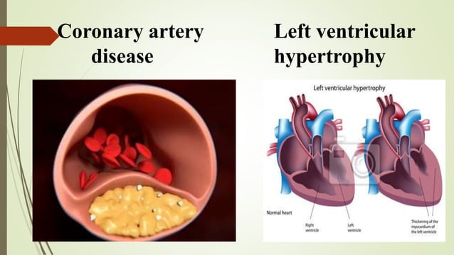 Hypertension slideshare | PPTX