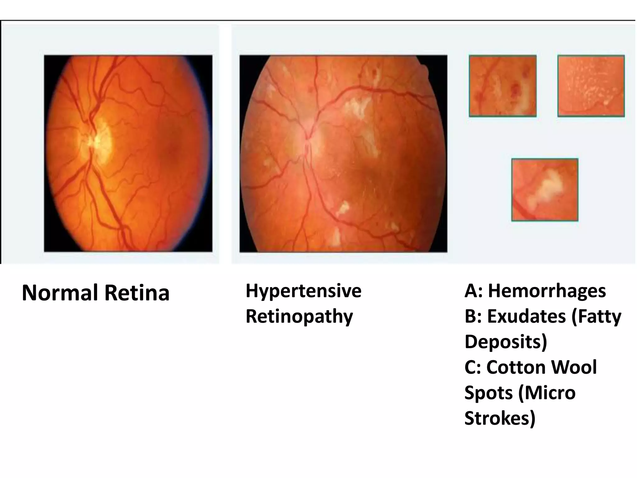 Hypertension | PDF
