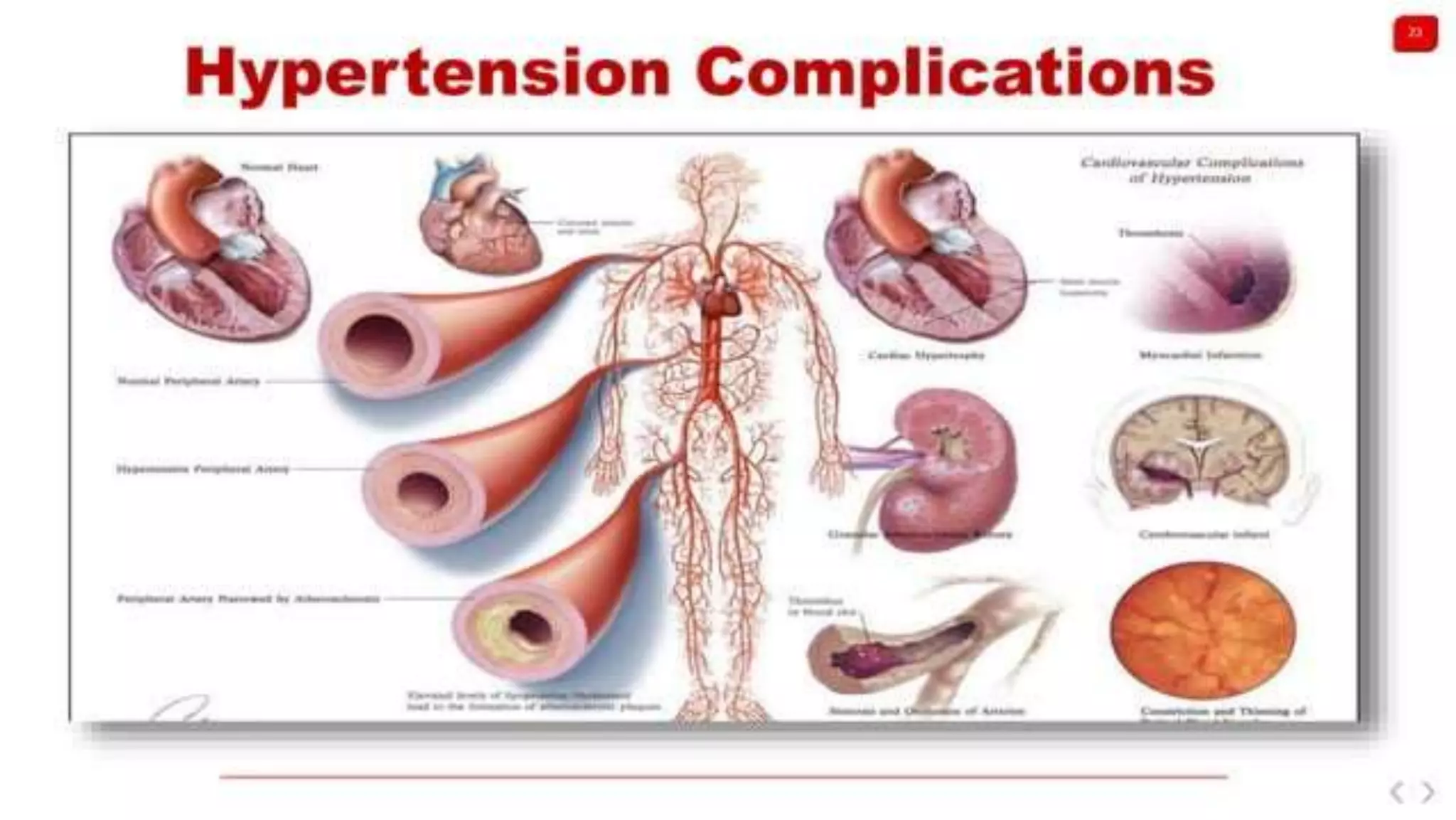 hypertension.pptx