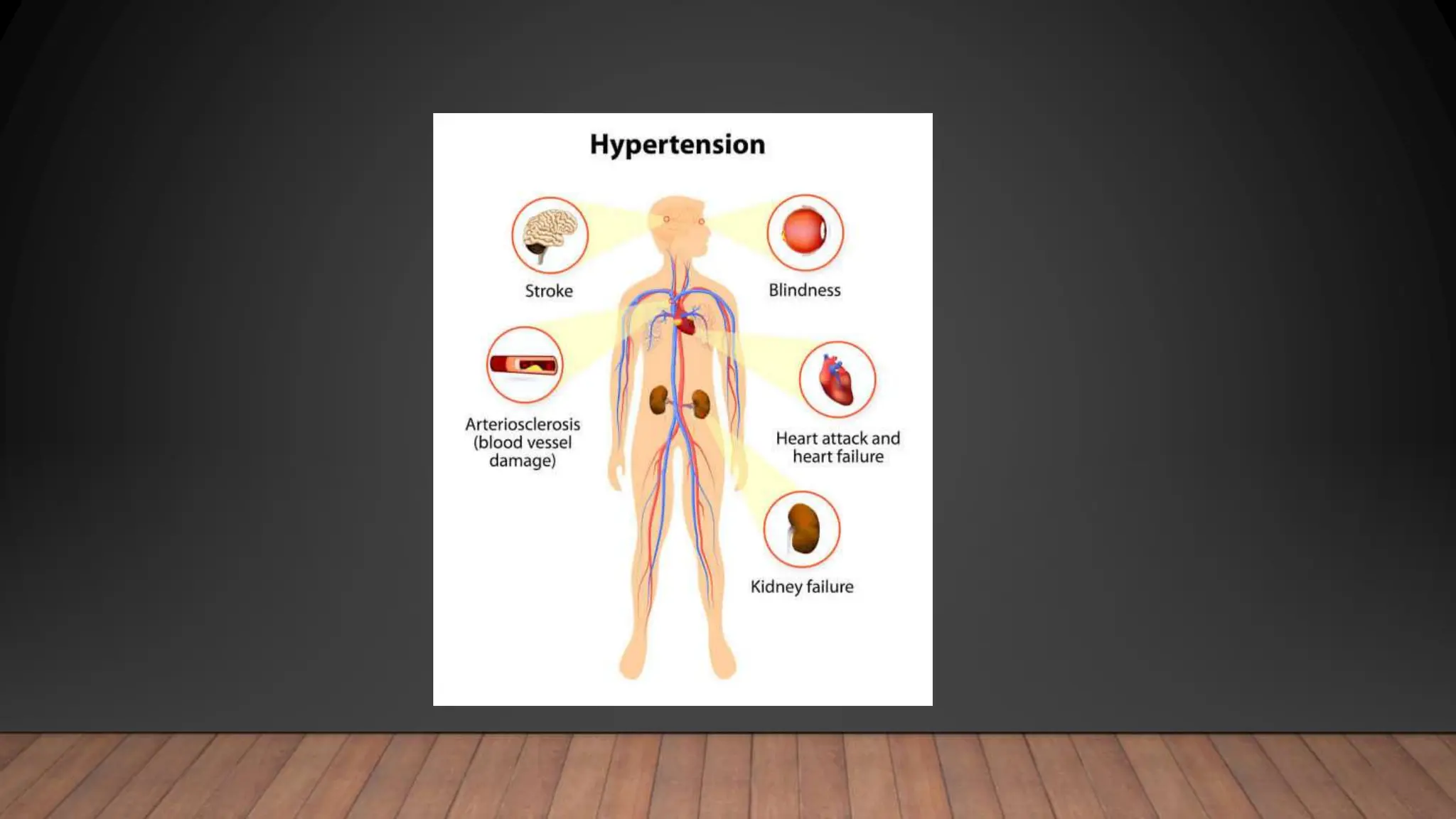 HYPERTENSION.pptx, mechanism and complications | PPTX