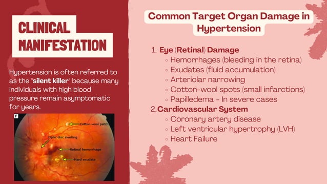 HYPERTENSION.pdf ward class power point presentation | PPT