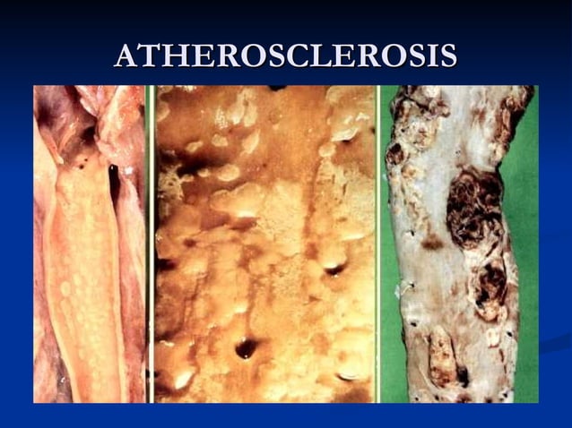 HYPERTENSION and classification and pathology | PPT